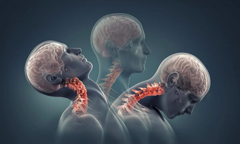 Cranio-Cervical Instability (CCI)/Cranio-Vertebral Instability (CVI ...